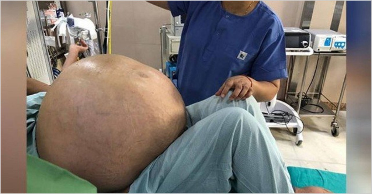 M dicos Ficam Perplexos Ao Retirarem Tumor Gigante Da Barriga Desta