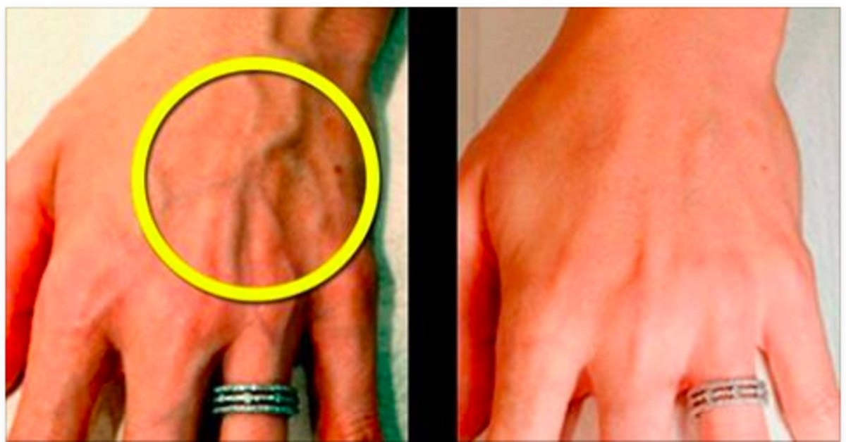 As veias de suas mãos estão ficando alteradas? Saiba o que isso ...